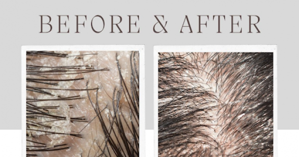 Unlocking the Secrets to a Flake-Free Scalp: Understanding and ...